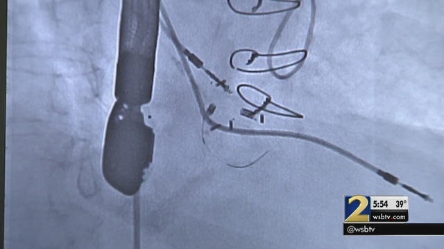 Piedmont Hospital performs first-of-its-kind heart surgery | WSB-TV
